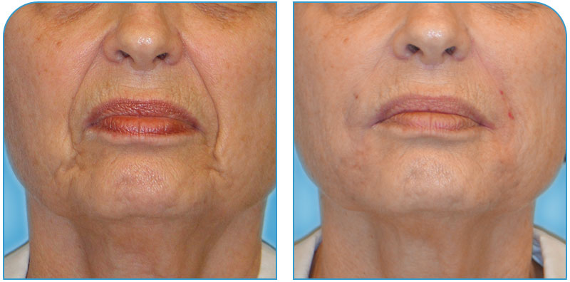 Marionette before and after 3 | facedoctorclinics.com.au